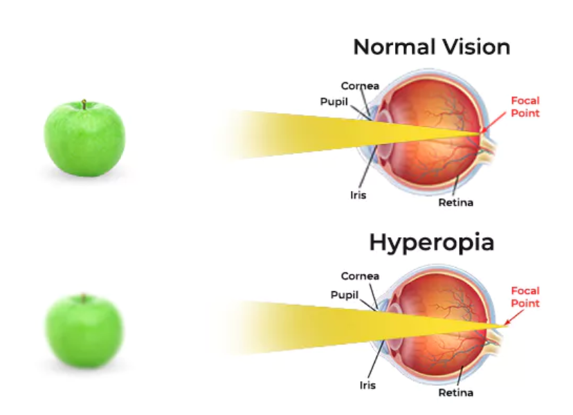 What is hyperopia? | SmartBuyGlasses AE