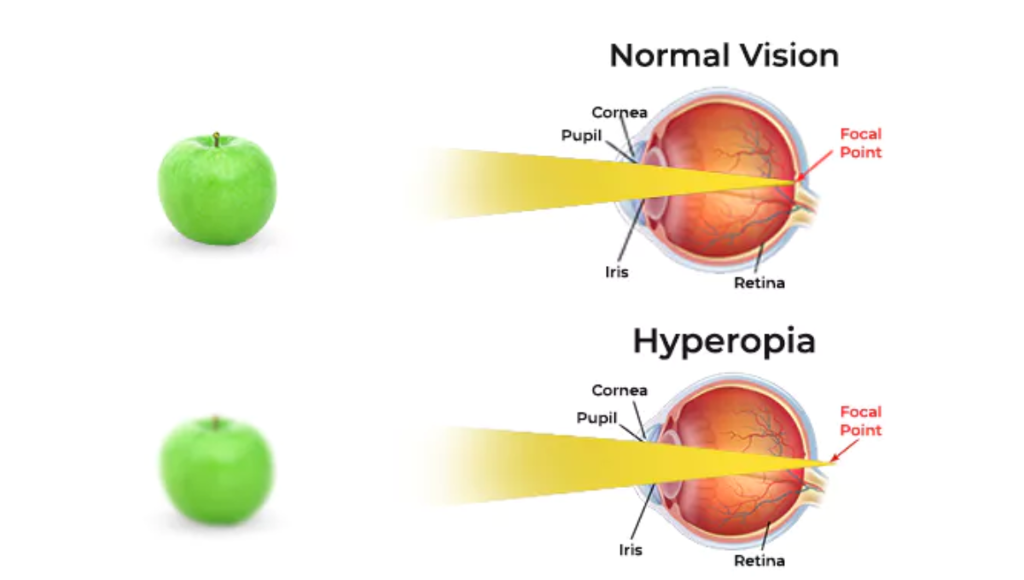 What is Hyperopia | SmartBuyGlasses CA