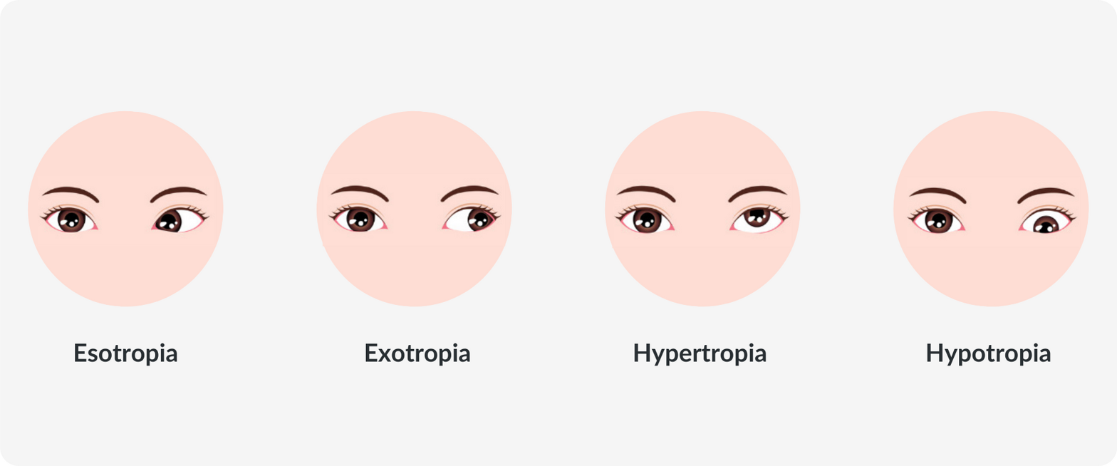 Eye Glasses for Strabismus - Full Guide | SmartBuyGlasses NZ