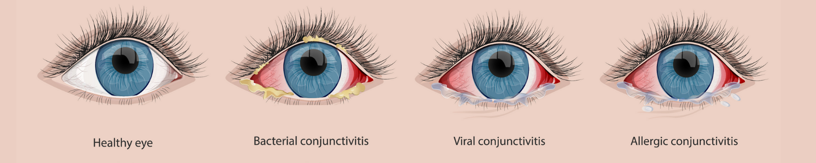 What Is Pink Eye? | How To Prevent Conjunctivitis | SmartBuyGlasses UK