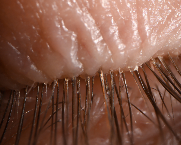 Eyelash Mites: Symptoms, Causes and Treatment | SmartBuyGlasses UK