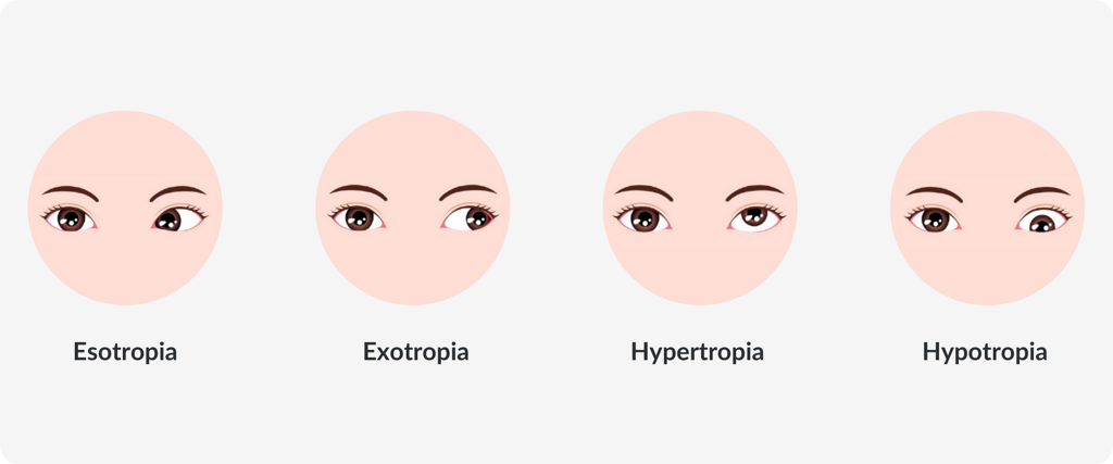 Eye Glasses for Strabismus - Full Guide | SmartBuyGlasses ZA