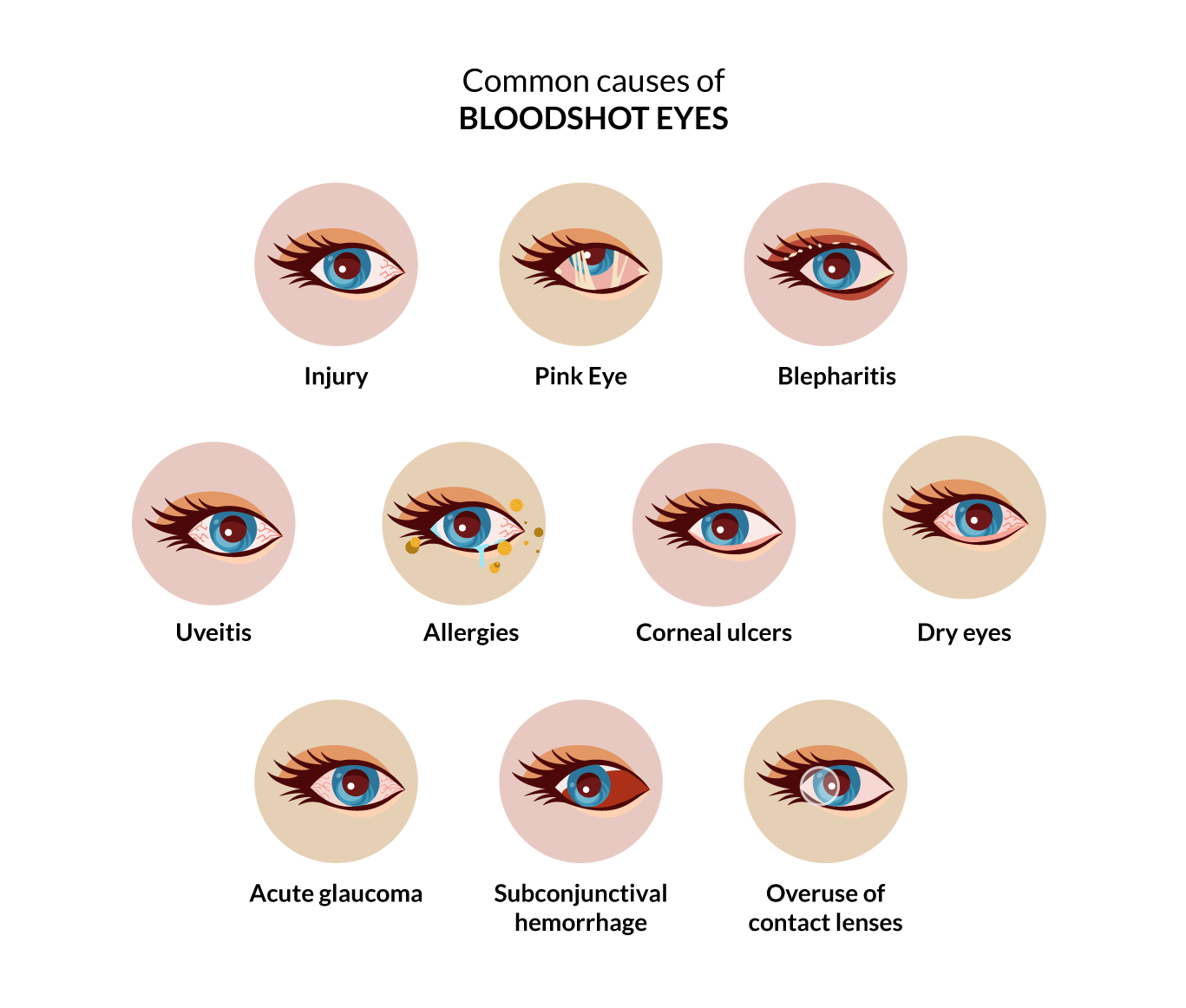 What causes bloodshot eyes? | SmartBuyGlasses US