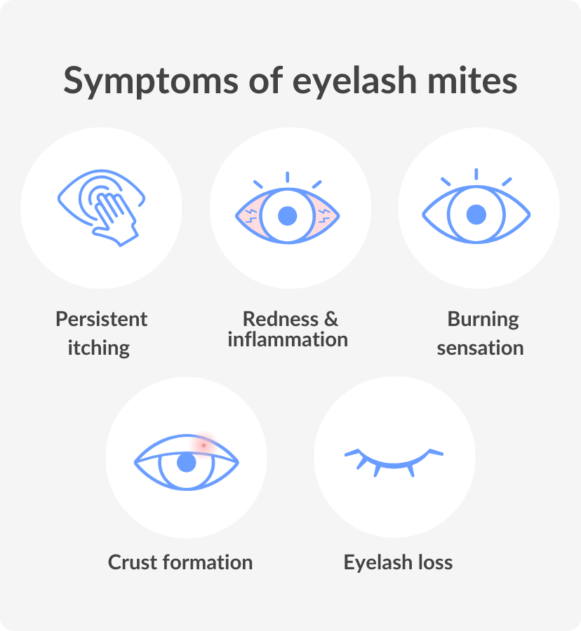 Eyelash Mites: Symptoms, Causes, and Treatment | SmartBuyGlasses US