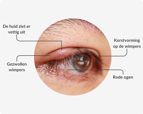 Blefaritis: Symptomen, oorzaken en mogelijke behandelingen ...