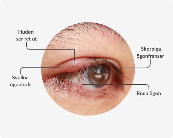Blefarit: symtom, orsaker och möjliga behandlingar | SmartBuyGlasses SE