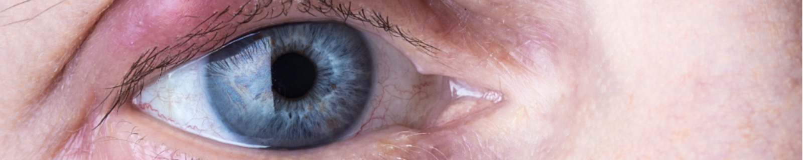 How To Get Rid of a Stye | Vision Direct AU