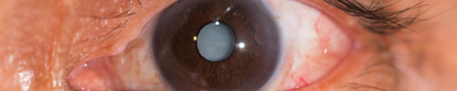 Cataracts | Symptoms Of Cataracts | Vision Direct AU