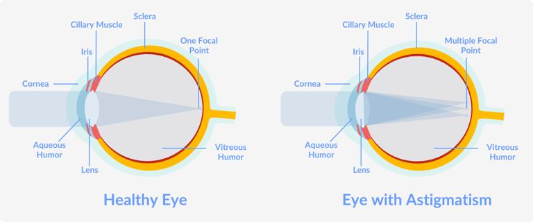 Astigmatism: causes, types, symptoms & treatment | Vision Direct AU