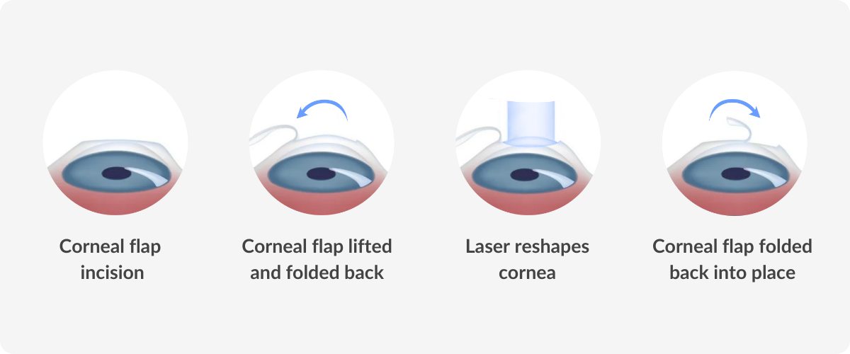 LASIK Eye Surgery | Optical Centre | Vision Direct AU