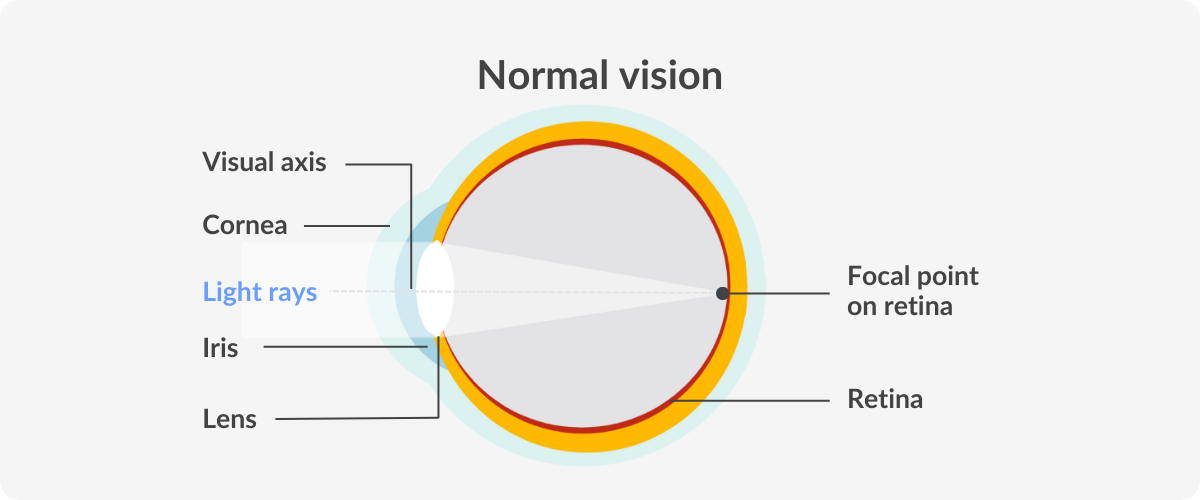 LASIK Eye Surgery | Optical Centre | Vision Direct AU