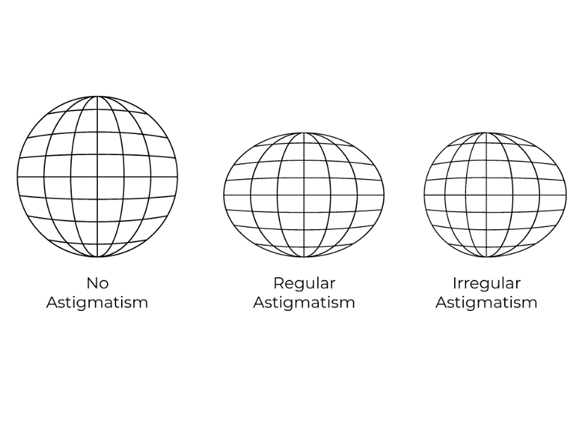 Astigmatism: causes, types, symptoms & treatment | Vision Direct AU