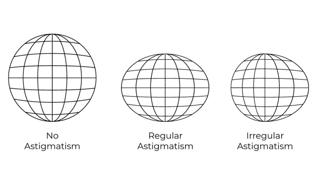Astigmatism: causes, types, symptoms & treatment | Vision Direct AU