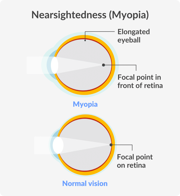 What Does "Nearsighted" Mean? | VisionDirect AU