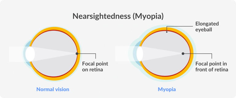 What Does "Nearsighted" Mean? | VisionDirect AU